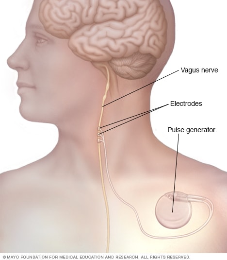 Vagus nerve stimulation - Mayo Clinic Vagus nerve stimulation - Mayo Clinic