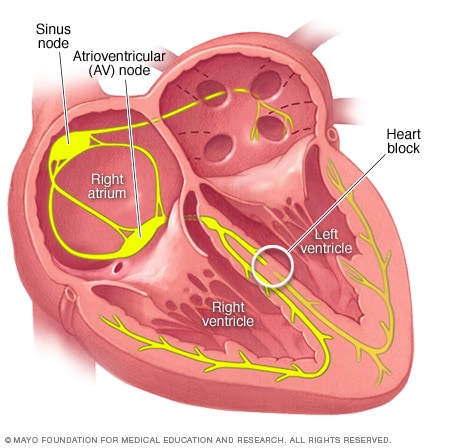 Bundle branch block - Mayo Clinic