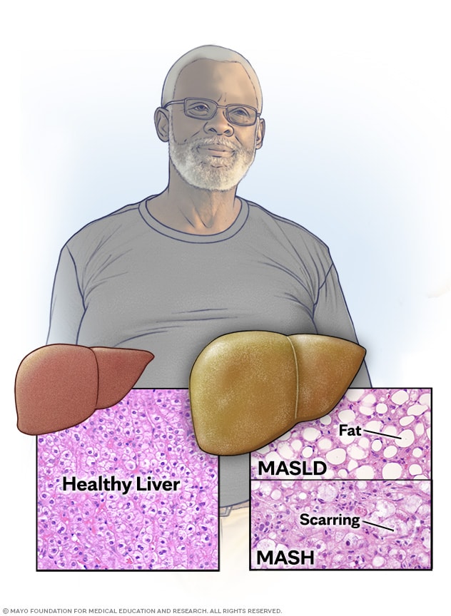 Nonalcoholic fatty liver disease - Symptoms and causes - Mayo Clinic