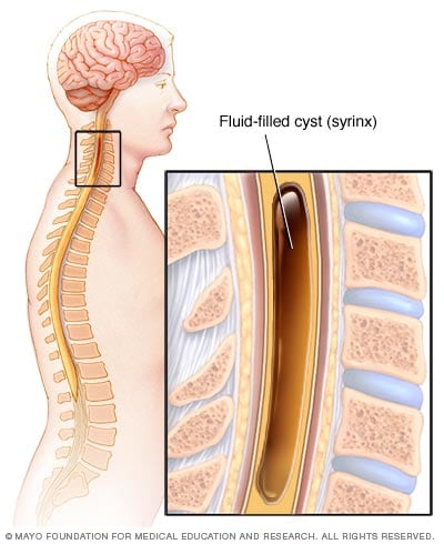 Syringomyelia - Symptoms and causes - Mayo Clinic