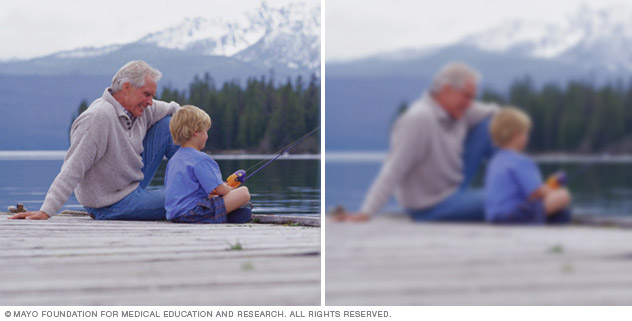Cataracts - Symptoms and causes - Mayo Clinic