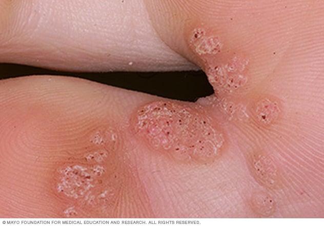 Plantar warts - Symptoms and causes - Mayo Clinic