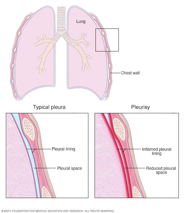 Pleurisy - Symptoms and causes - Mayo Clinic