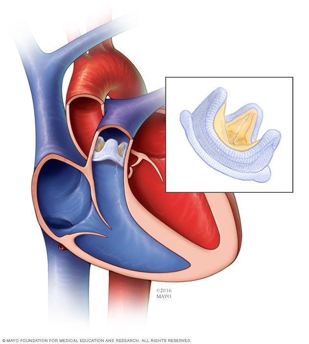 Pulmonary valve repair and replacement - Mayo Clinic