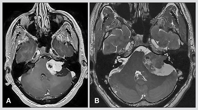 Verona Geographer Acoustic Neuroma [PDF] Pain. Part 7: Trigeminal ...