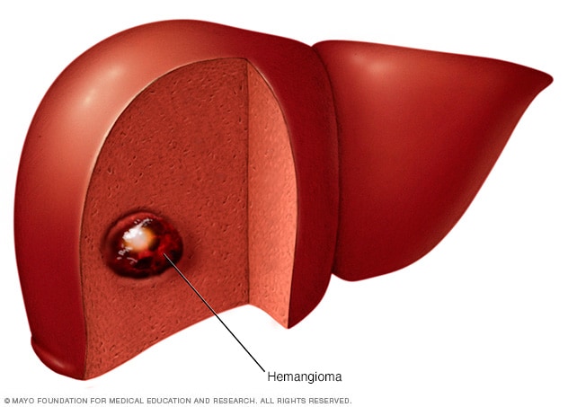 Liver hemangioma - Symptoms and causes - Mayo Clinic
