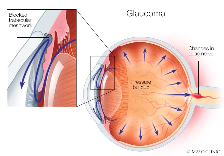 Closed Angle Glaucoma Vs Open Angle Closed Angle Glaucoma Vs Open Angle