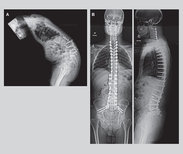 Specialized expertise for spinal deformity surgery - Mayo Clinic