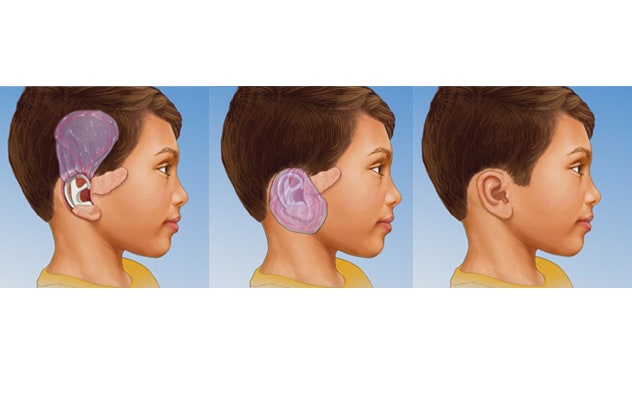 Early intervention, innovations improve outcomes for ear reconstruction ...