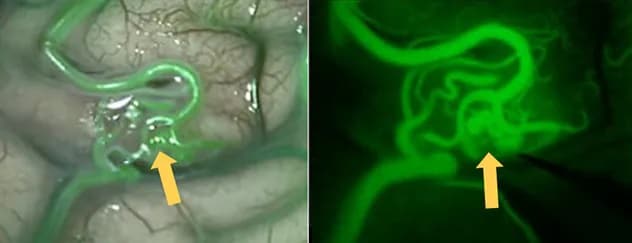 AVMs: Multimodal approach for individualized treatment - Mayo Clinic