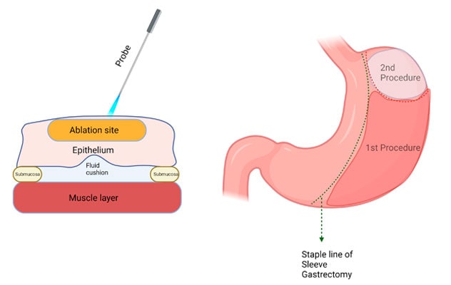 Small bowel endoluminal bariatric and metabolic therapies - Mayo Clinic