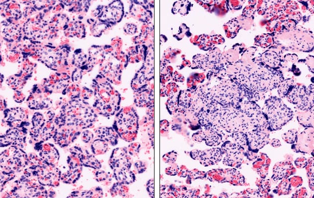 Mayo Clinic investigators surprised: Fetal surgery not associated with ...