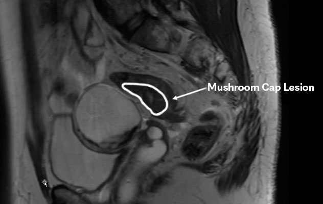 Management of deep bowel endometriosis - Mayo Clinic