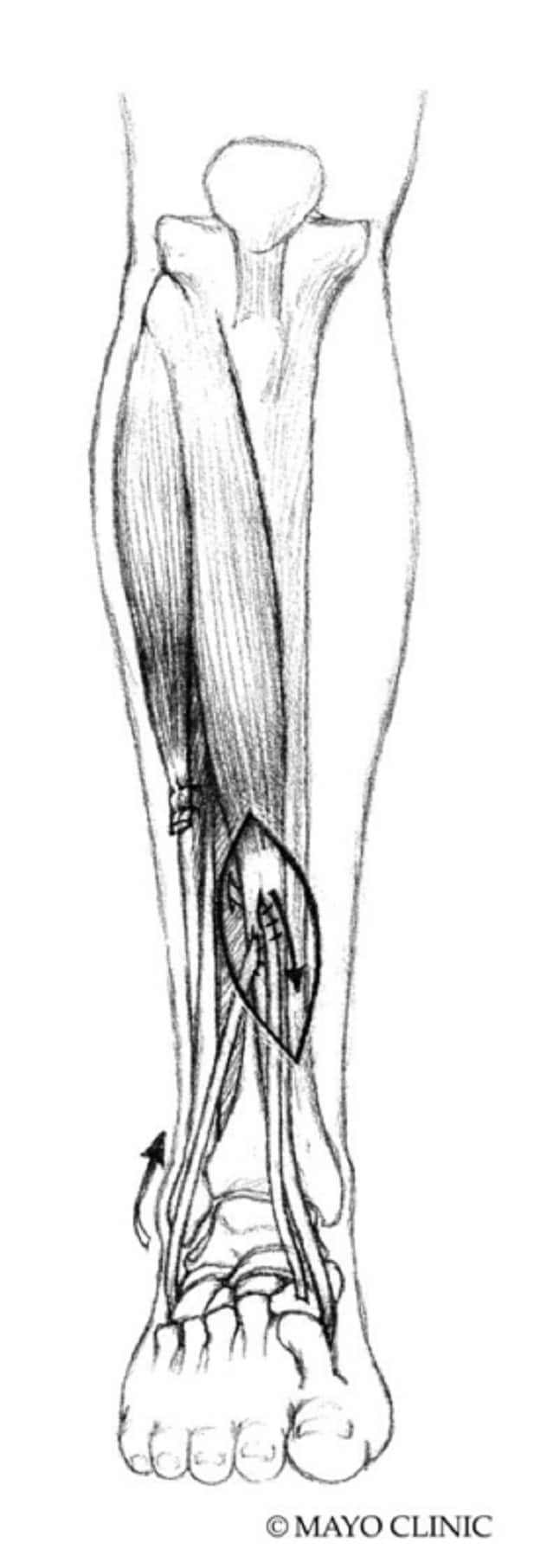 High satisfaction rates and positive outcomes for Bridle procedure for ...