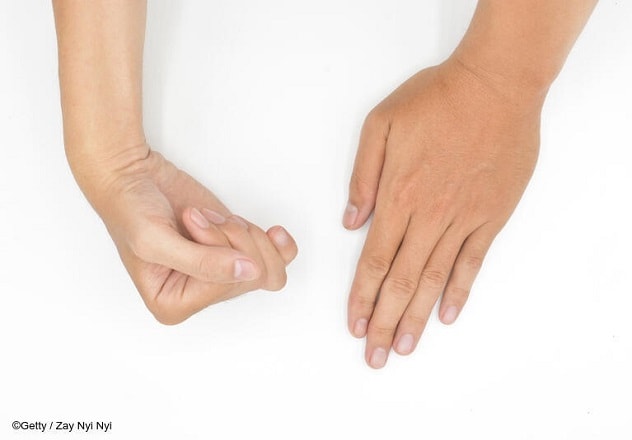 Upper extremity reconstruction for adult brain injury resulting in ...