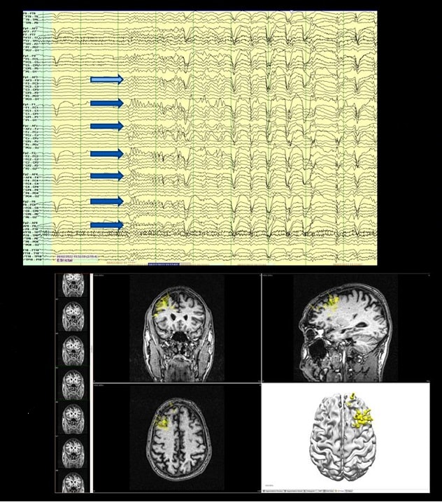 MEG enhances precision of focal epilepsy localization - Mayo Clinic