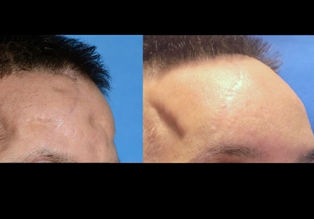 Craniofacial surgery enhances brain tumor care - Mayo Clinic