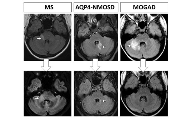 MOGAD Clinic: World-class expertise for a disabling autoimmune disease ...