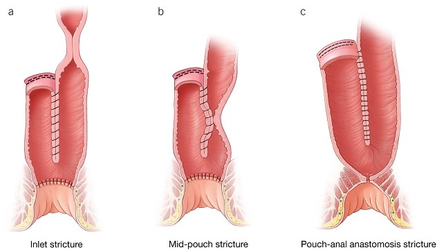 J-pouch disorders: Classification and management - Mayo Clinic