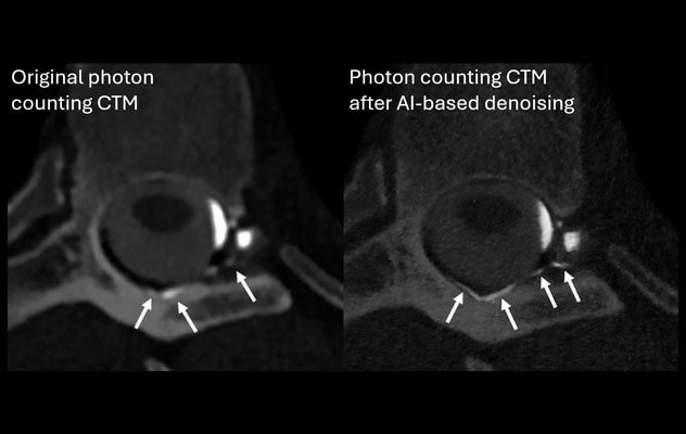 Intracranial hypertension after CSF leak might signal an underlying ...