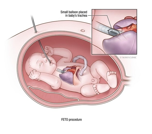 Multisite study finds FETO associated with reduced postbirth ECMO for fetuses with CDH - Mayo Clinic