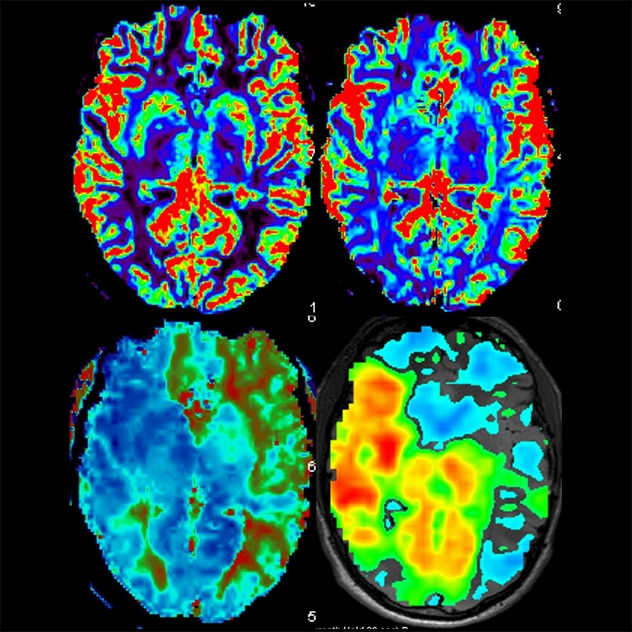 Unique imaging protocol facilitates moyamoya disease management - Mayo ...