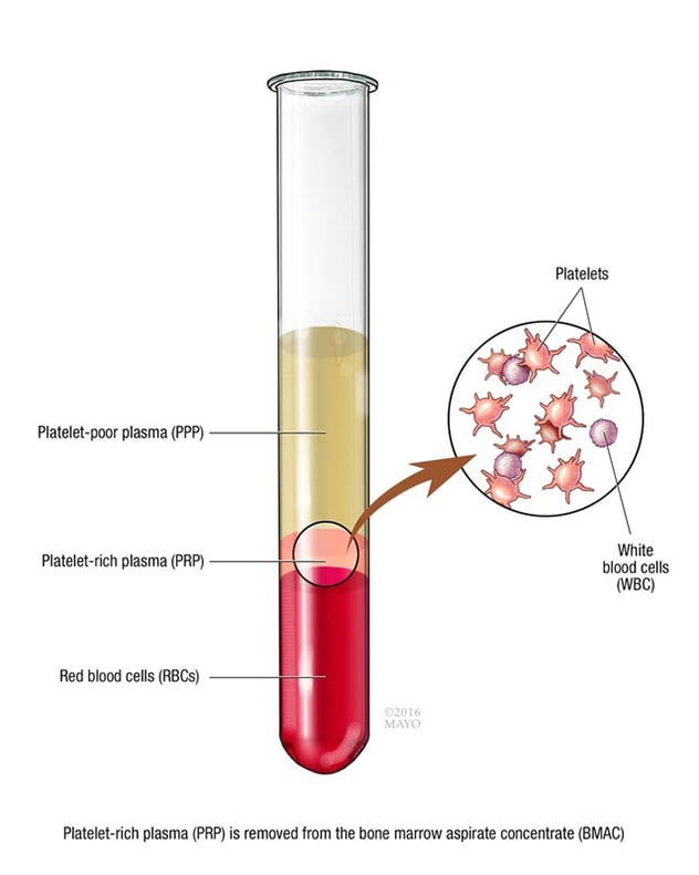 Analyzing the performance of platelet-rich plasma and bone marrow aspirate concentrate ...