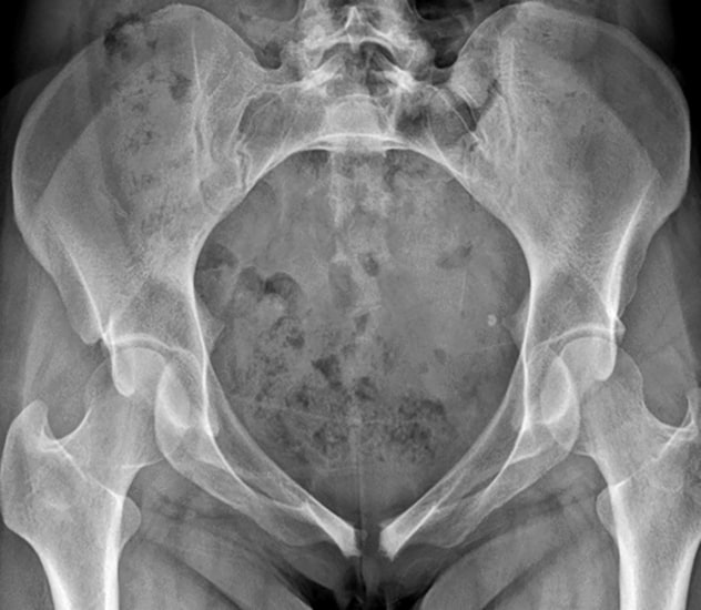 Mayo Clinic orthopedic surgeon devises repair for previously inoperable ...