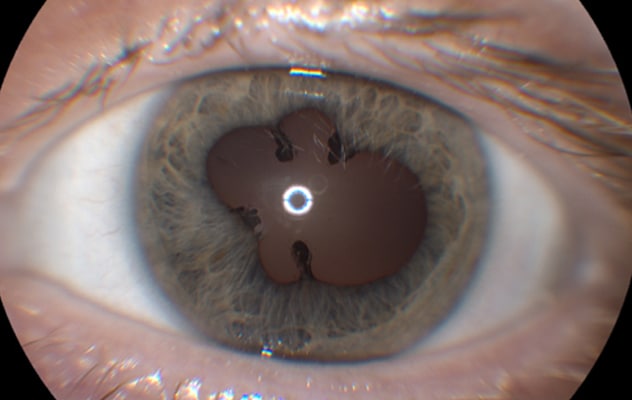 posterior synnechiae