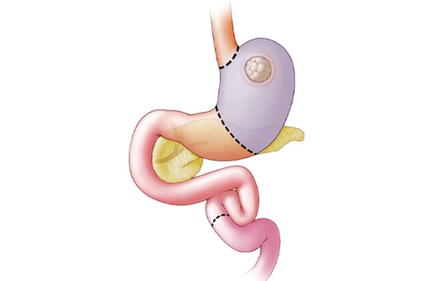 Modified proximal gastrectomy offers benefits for locally advanced GEJ adenocarcinoma - Mayo Clinic