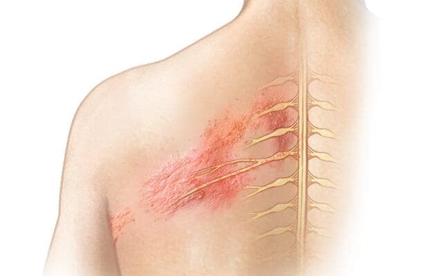 Examining the impact of herpes zoster (HZ) and HZ vaccination in ...