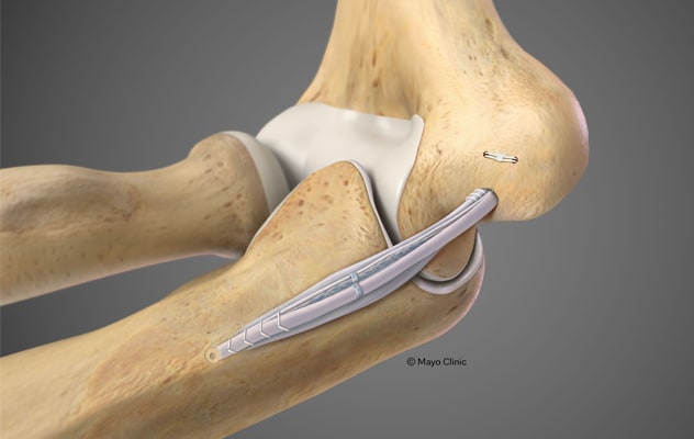 Getting athletes with MUCL injuries back to sport - Mayo Clinic