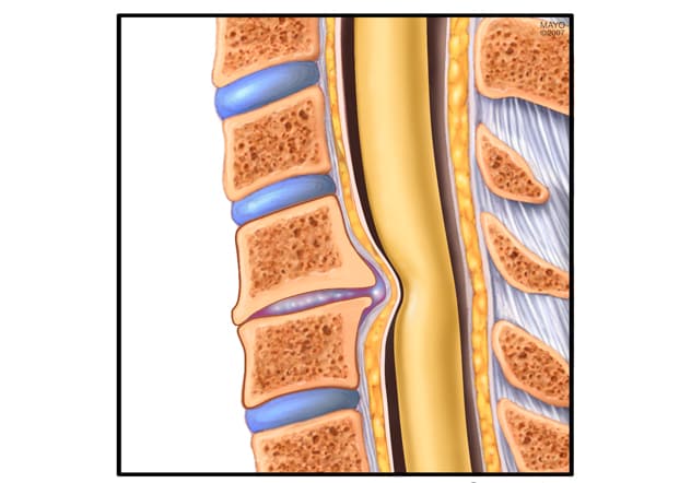 Q&A: Cervical herniated disk - Mayo Clinic