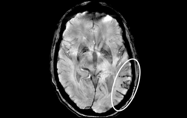Balancing the risks of antiamyloid therapies - Mayo Clinic