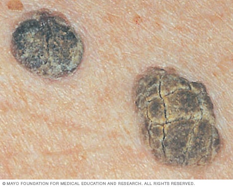 Close-up of seborrheic keratoses - Mayo Clinic