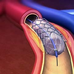 Video: Coronary angioplasty - Mayo Clinic
