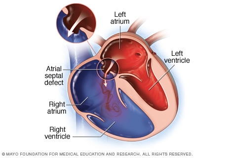 Atrial septal defect - Mayo Clinic