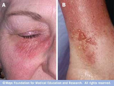 Contact Dermatitis Blisters