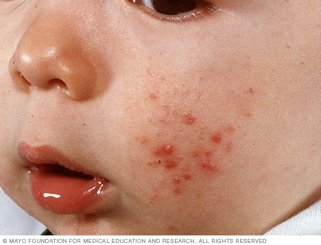 Acné en la mejilla de un bebé - Mayo Clinic