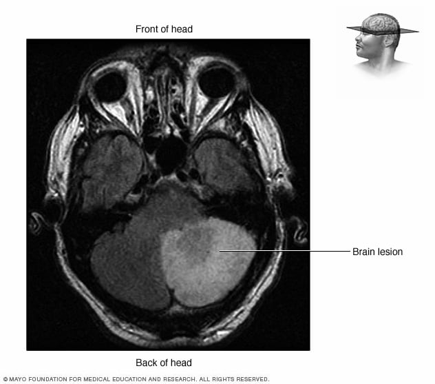 Brain lesion on MRI - Mayo Clinic