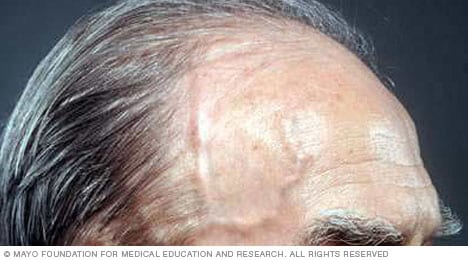 Giant cell arteritis - Mayo Clinic