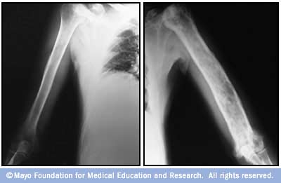 Paget's disease of bone - Mayo Clinic