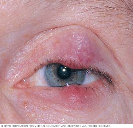Chalazion - Mayo Clinic