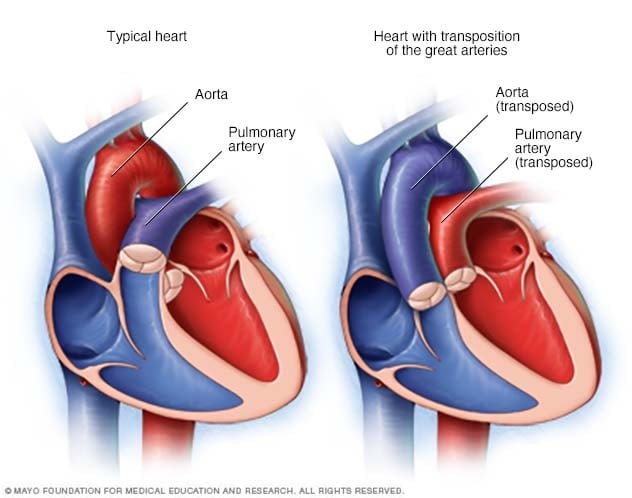 Transposition of the great arteries - Mayo Clinic