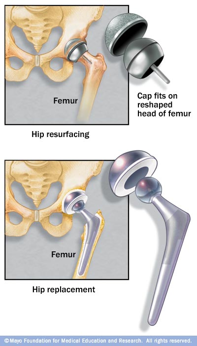 Hip resurfacing - Mayo Clinic