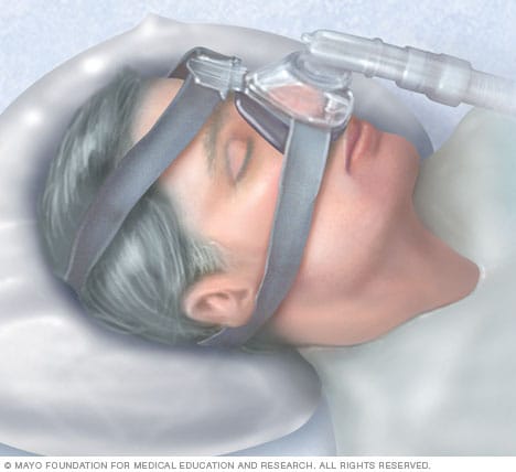 Continuous positive airway pressure (CPAP) - Mayo Clinic