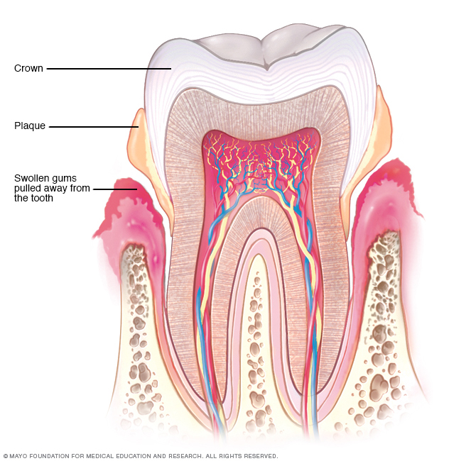Periodontitis - Symptoms and causes - Mayo Clinic Periodontitis - Symptoms and causes - Mayo Clinic