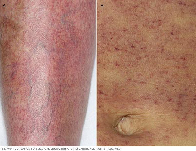 Petechiae - Mayo Clinic