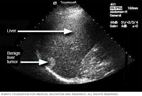 Ultrasound of liver tumor - Mayo Clinic