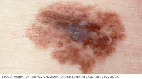 Slide show: Melanoma pictures to help identify skin cancer - Mayo Clinic